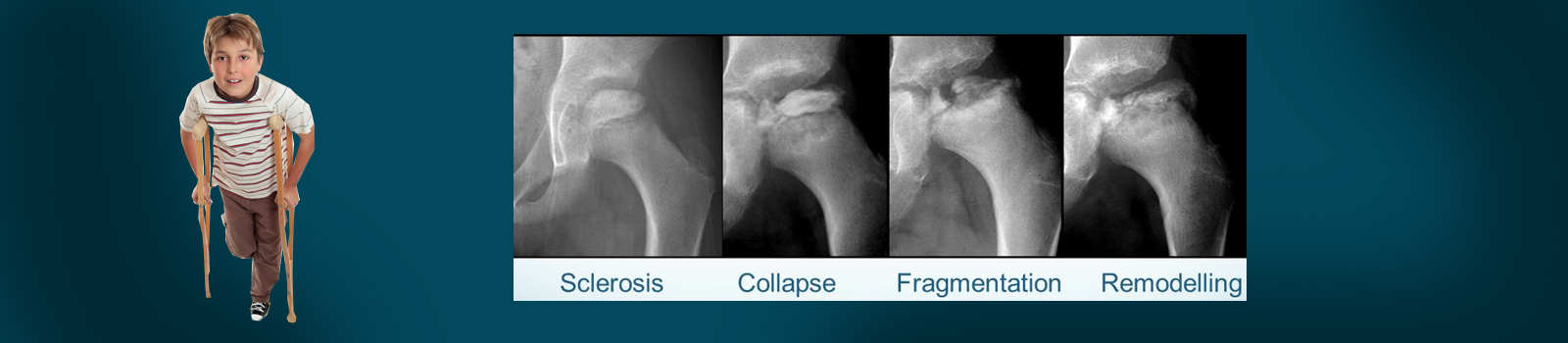 Perthes Disease - Dr. Dayanandan's Homeo Clinic